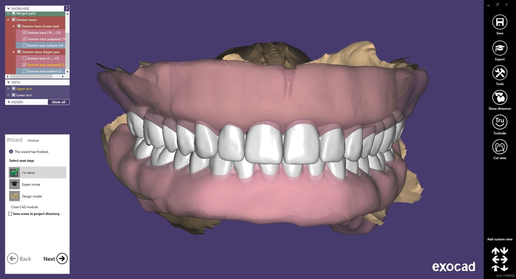 Double Arch Allon4 Immediate Prosthesis with exocad Plovdiv - Milled ...