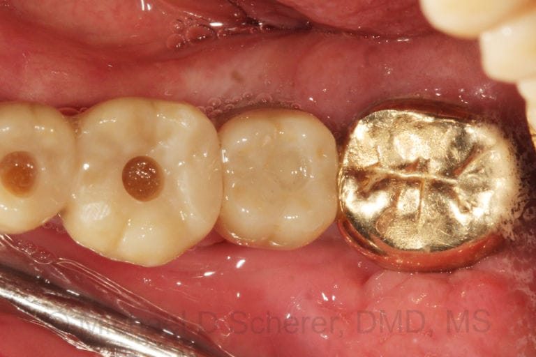 Super Fast In-Office Screw-Retained Zirconia Crowns in HOURS (Not Weeks ...