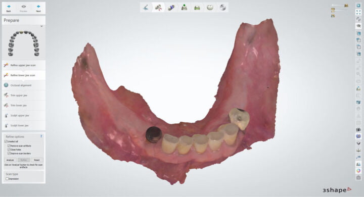 Intraoral Scanning Partials Using the LOCATOR Scan Body - LearnDentistry™