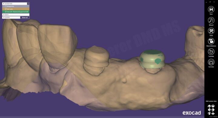 Intraoral Scanning Partials Using the LOCATOR Scan Body - LearnDentistry™