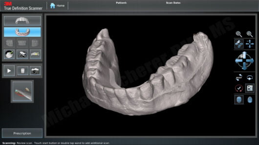 The “Reference Denture Technique” - Key for Simplifying Digital Denture ...