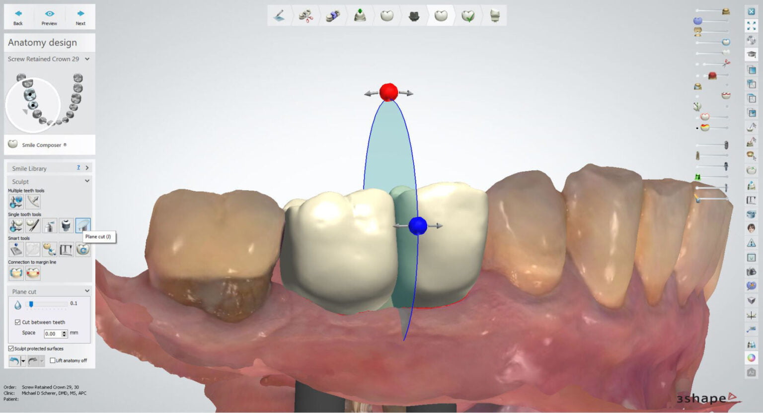Using the Plane Tool to Make Contacts Between Adjacent Implants Ideal ...