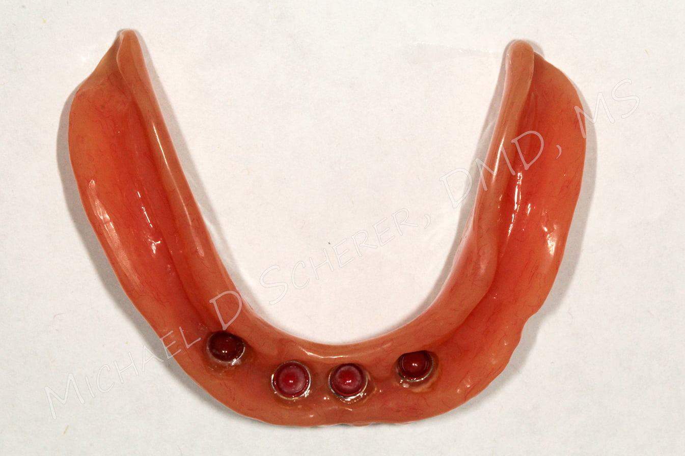 Recommended Follow-up Appointments and Checking Inserts for LOCATOR ...