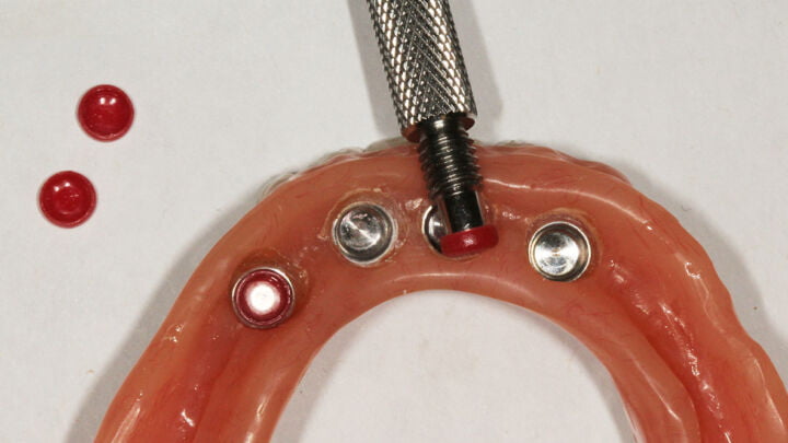 Implant Overdentures Archives LearnDentistry implant-overdentures-archives-learndentistry