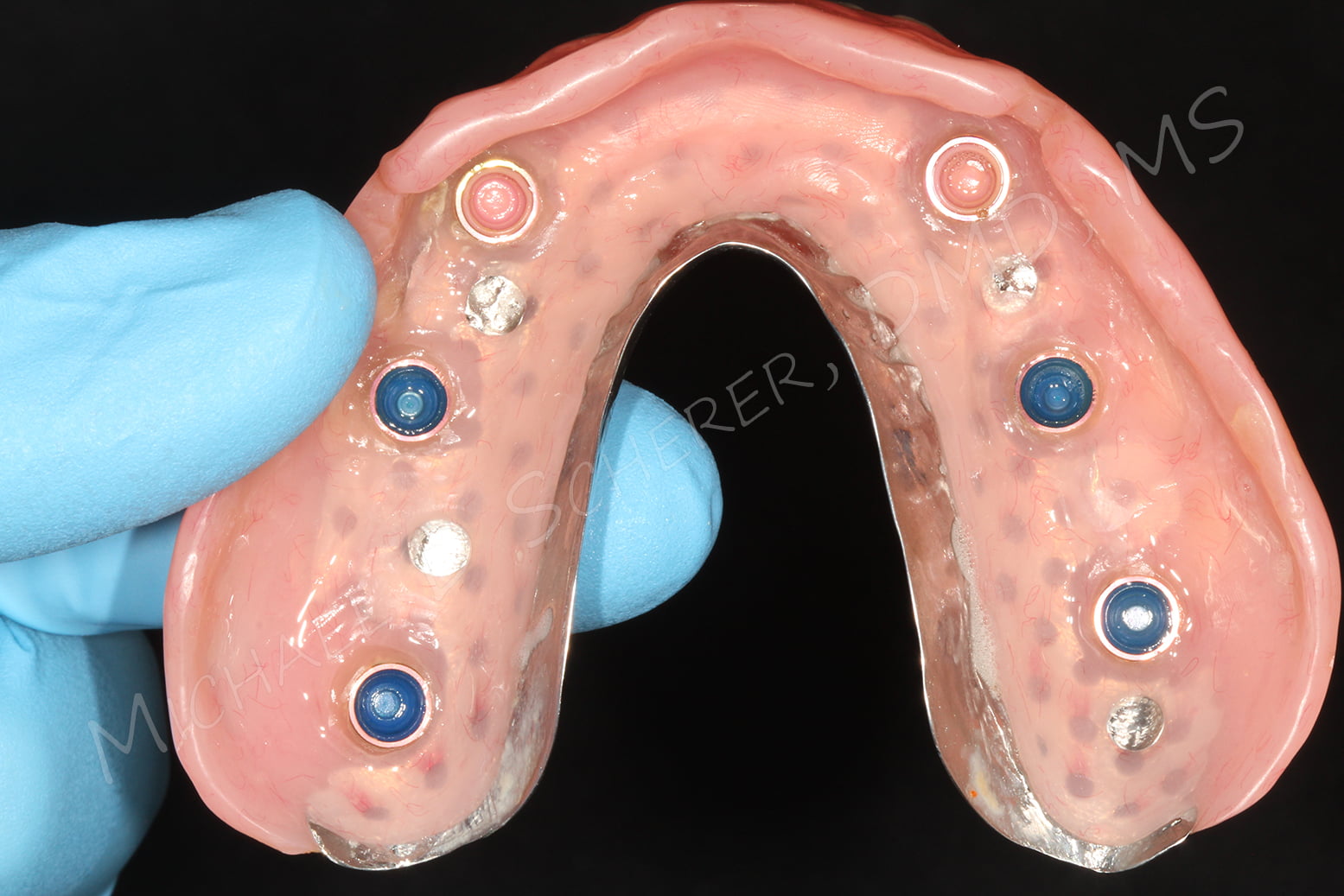 Recommended Follow-up Appointments and Checking Inserts for LOCATOR ...