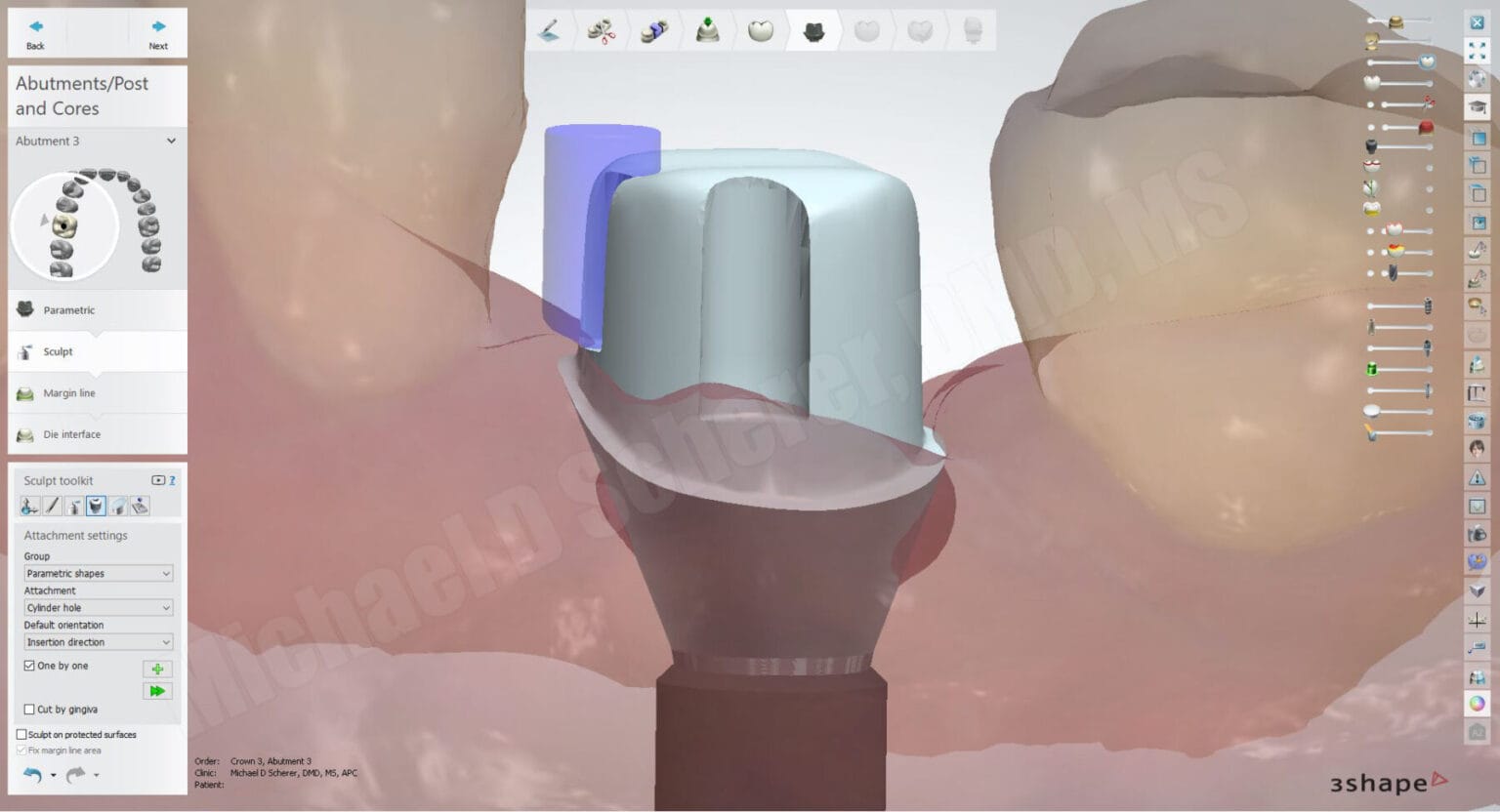 Milling Your Own Custom Titanium Abutments & Split-File Crowns ...