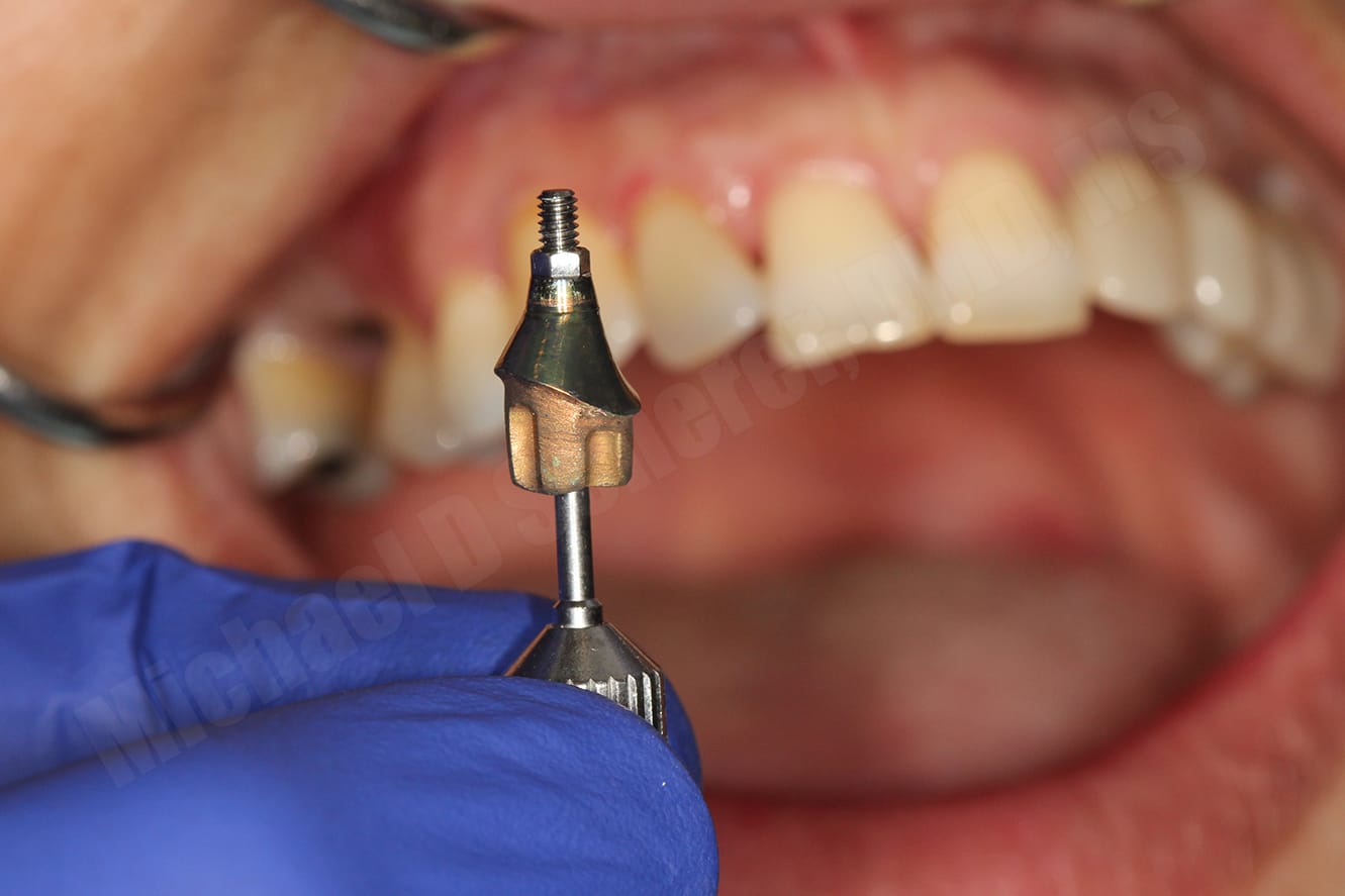 Milling Your Own Custom Titanium Abutments & Split-File Crowns