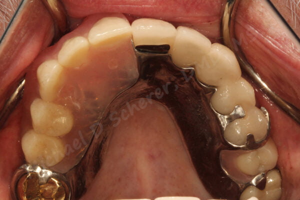 Root Resurgence - LOCATOR Root is Back! - LearnDentistry™