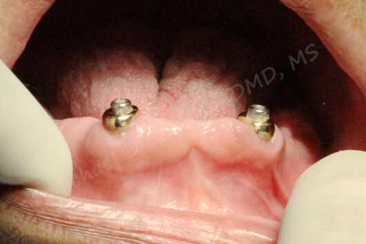 How Much Space in a Denture Do I Need for a LOCATOR? How to Avoid the ...