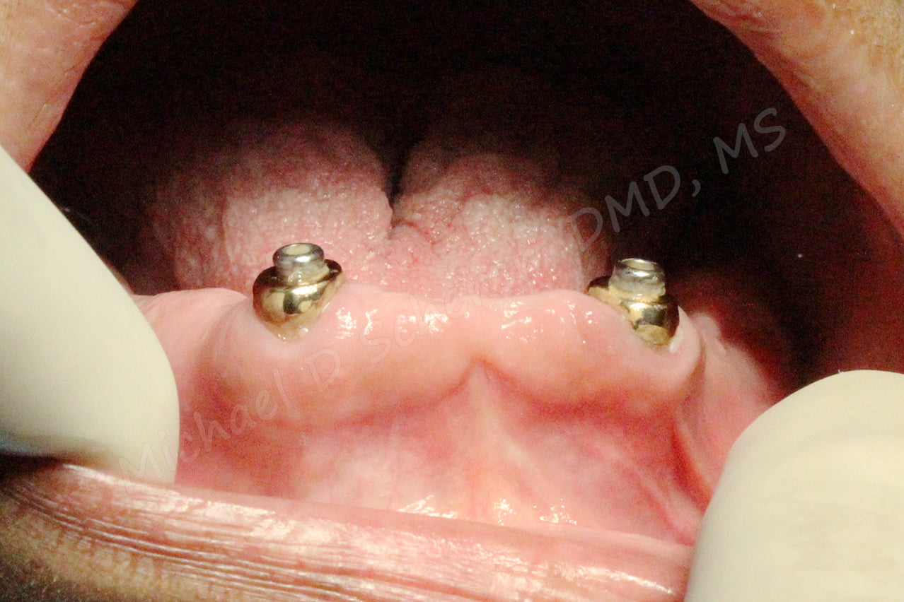 How Much Space in a Denture Do I Need for a LOCATOR? How to Avoid the ...