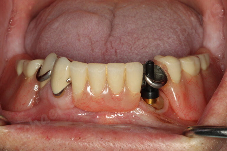 Root Resurgence - LOCATOR Root is Back! - LearnDentistry™