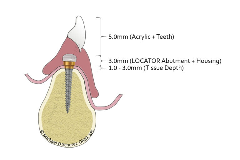 How Much Space in a Denture Do I Need for a LOCATOR? How to Avoid the ...