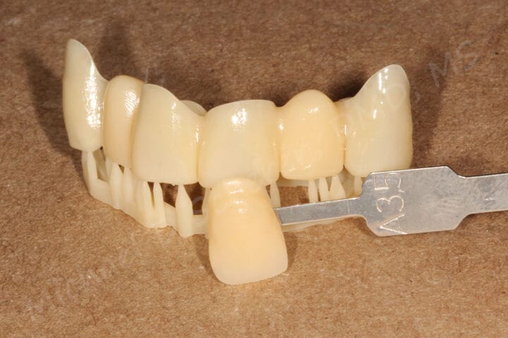 How to Design & 3D Print Your Own In-Office Shell Temps! - LearnDentistry™