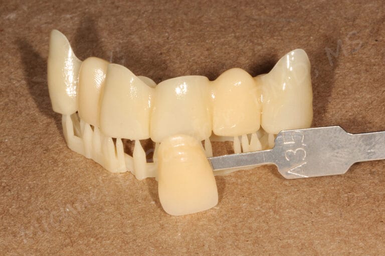 How to Design & 3D Print Your Own In-Office Shell Temps! - LearnDentistry™