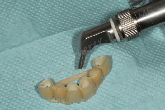 How to Design & 3D Print Your Own In-Office Shell Temps! - LearnDentistry™