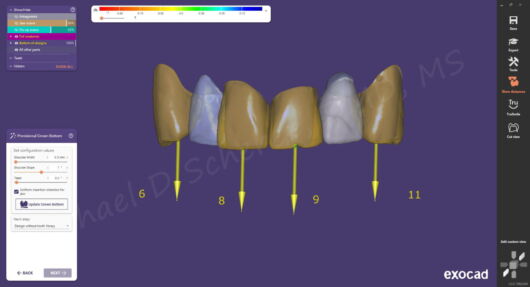 How to Design & 3D Print Your Own In-Office Shell Temps! - LearnDentistry™
