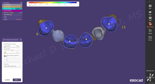 How to Design & 3D Print Your Own In-Office Shell Temps! - LearnDentistry™
