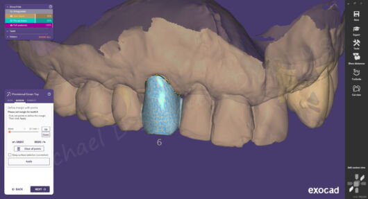 How to Design & 3D Print Your Own In-Office Shell Temps! - LearnDentistry™