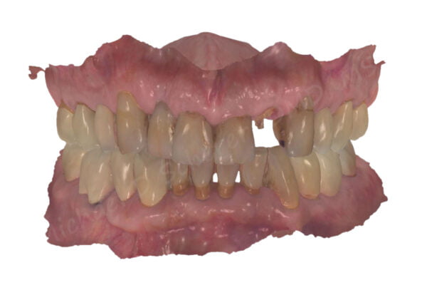 How to Design & 3D Print Your Own In-Office Shell Temps! - LearnDentistry™